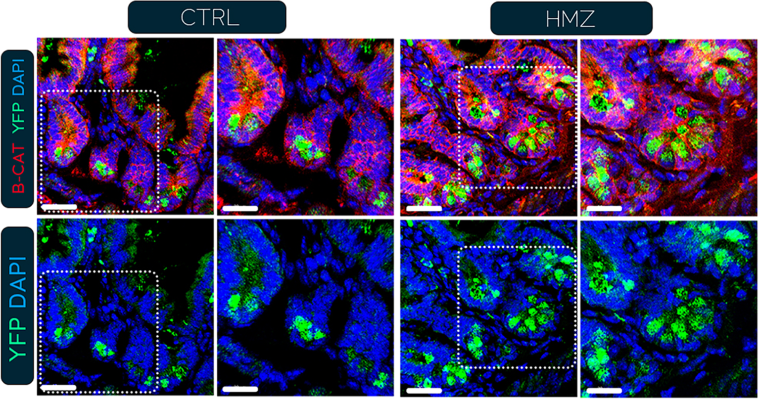 Research Paper: Defective HNF1A hinders GLI3 processing favoring ...